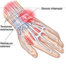 ¿Que es una tendinitis? -Fisioterapia - Fisioterapia Playamar